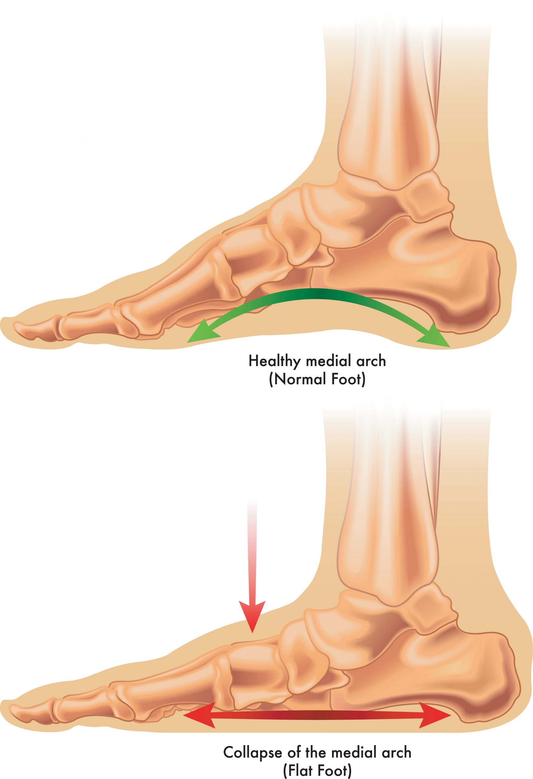 Arch Pain and Arch Strain