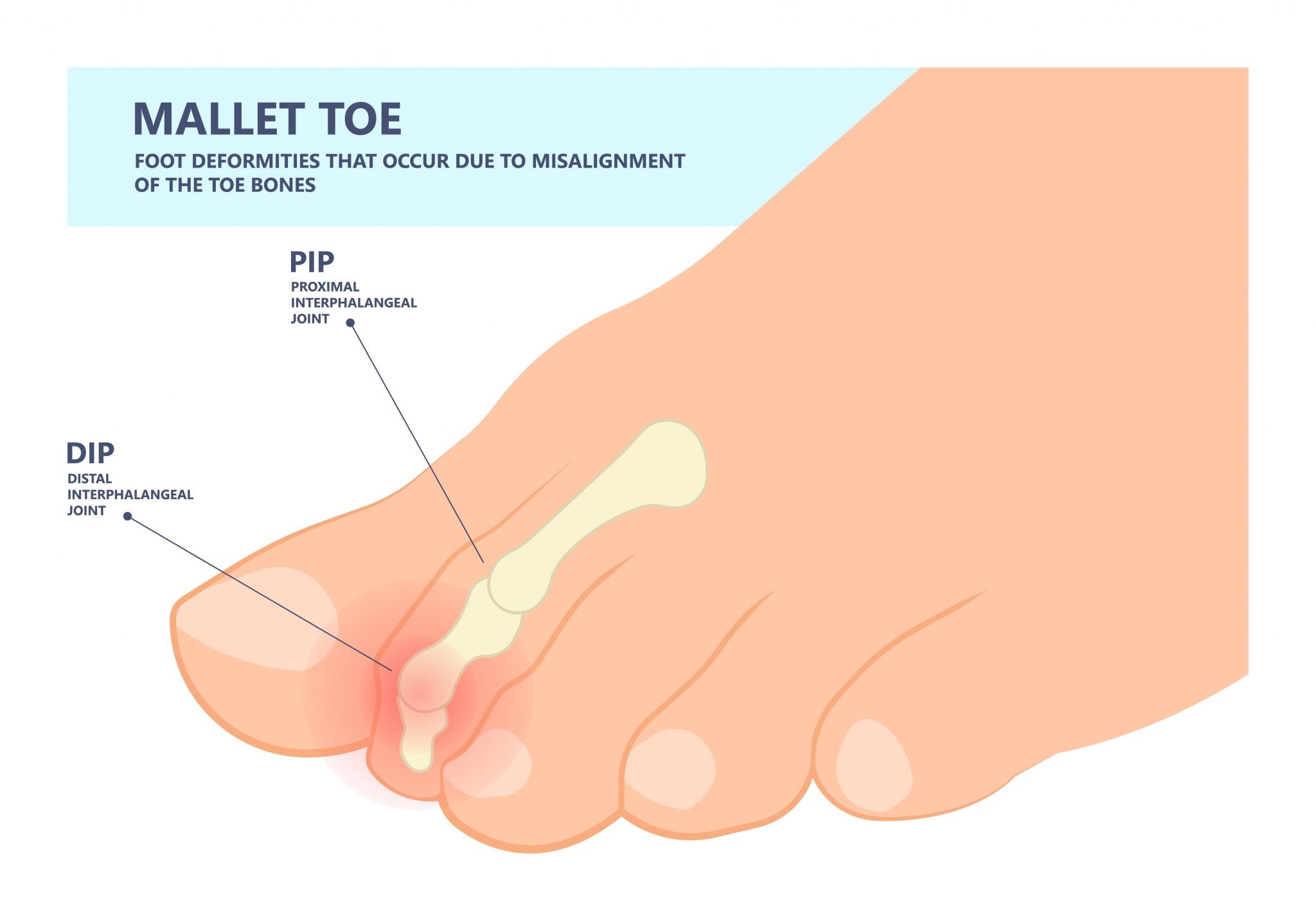 Mallet Toes; Orthotic and Diabetic Footwear